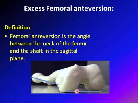 Internal Tibial Torsion - Pediatrics - Orthobullets