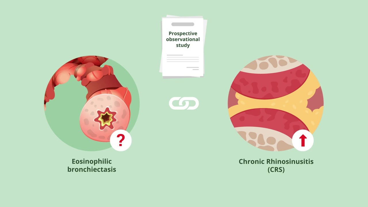 Bronchiectasis With Chronic Rhinosinusitis  Insights on Inflammation and Distinction From Asthma