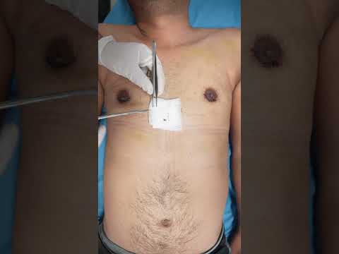Gynecomastia surgery in delhi | Manboobs Surgery cost