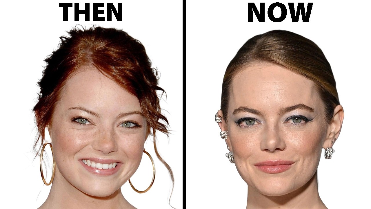 Emma Stone's NEW FACE | Plastic Surgery Analysis
