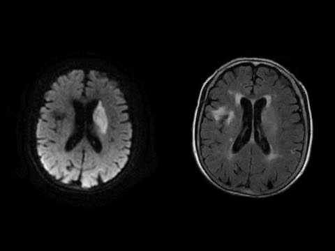 Stroke. Left MCA Occlussion. Distal aspiration + Stentriever