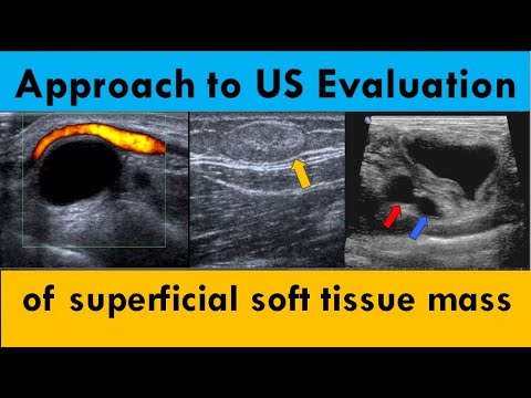 Approach to ultrasound evaluation of superficial soft tissue mass