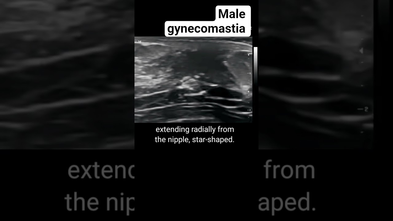 Male gynecomastia on ultrasound #radiology #ultrasound