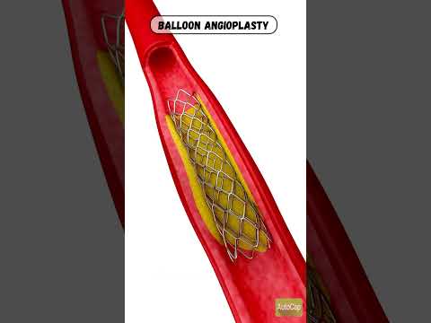 Balloon angioplasty | angioplasty | central vein balloon angioplasty | Angioplasty animation