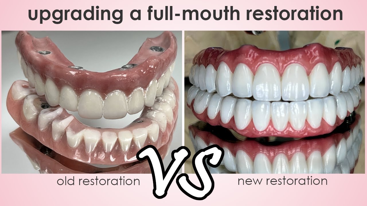 Replacing a Screw-Retained Restoration with a Futuristic Full-Mouth Solution