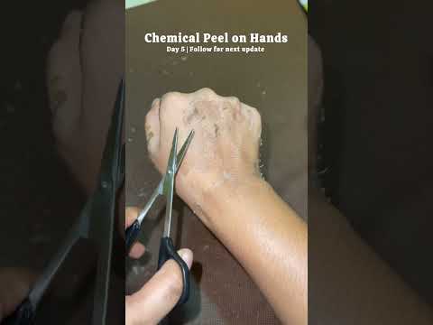 TCA 25% Chemical Peel on Hands - Day 5 Peeling Update! 🌸✨