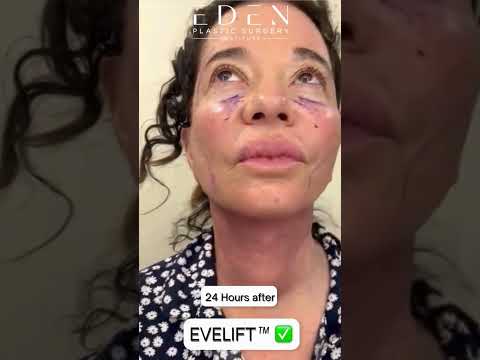 EVE Lift™ Patient Before & After One Day Post Op | Eden Plastic Surgery: Dr. Ali Charafeddine Miami
