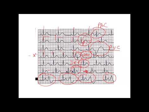 EKG Practice Strips