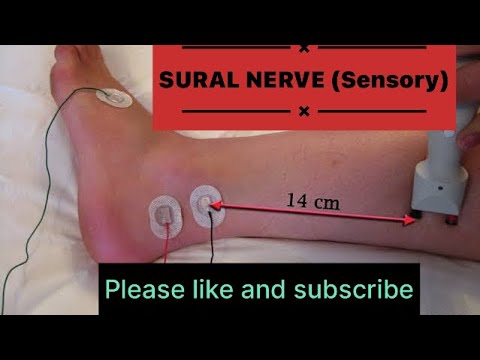 SURAL NERVE | SURAL NERVE conduction study | ncs of sural nerve #AFMC #neurology #neurotech