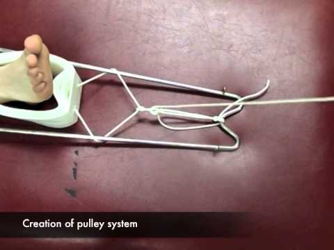 RCS Annals Technical Tip: Effortless tension for splint