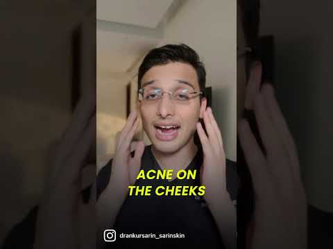 Getting acne on specific areas of the face?? || Dr Ankur Sarin ||