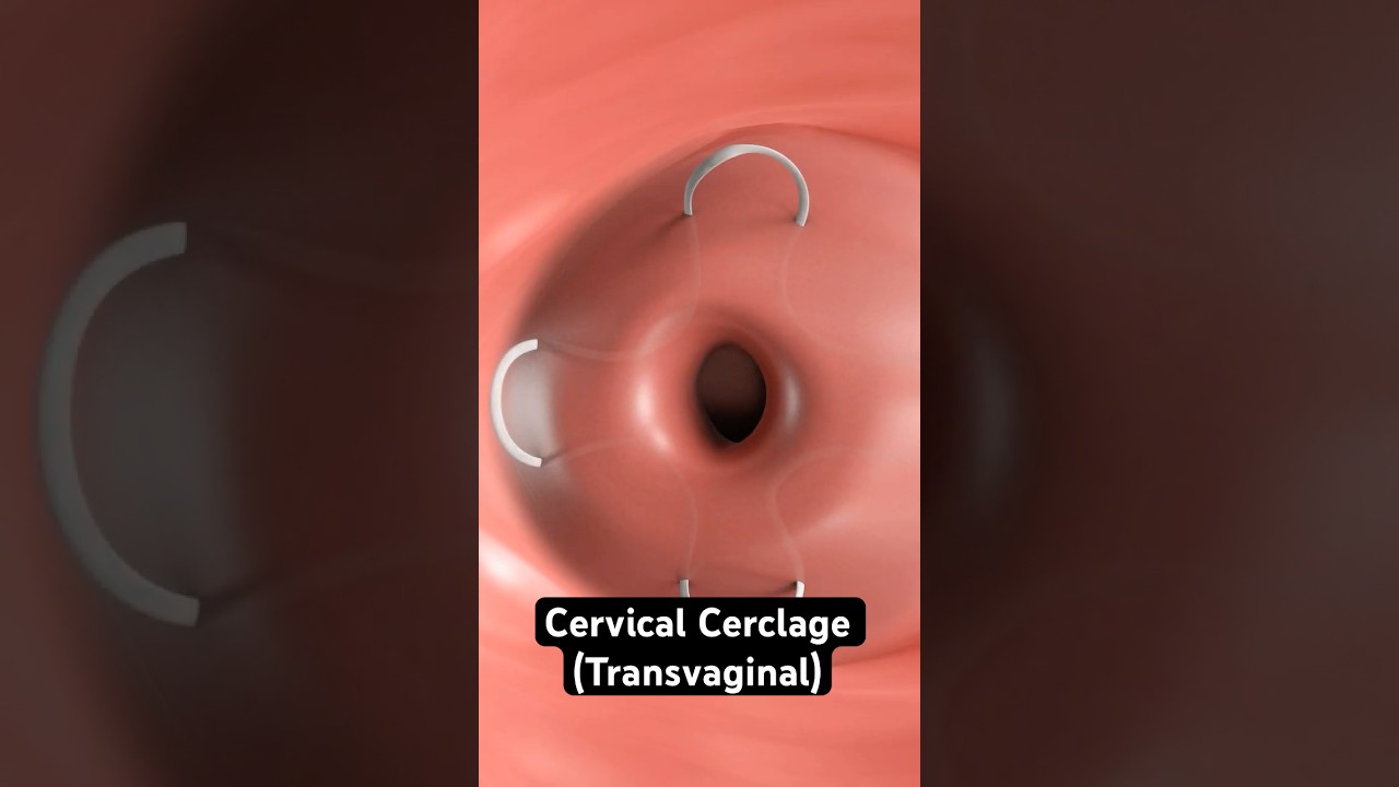 Stitching the cervix to prevent miscarriage (3D animation