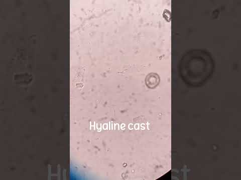Hyaline cast in Urine