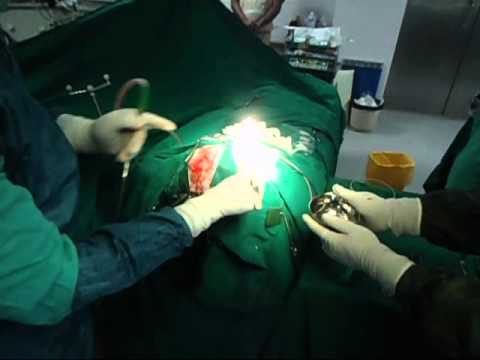 Brain abcsess surgery