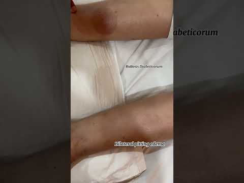 Bullosis Diabeticorum #subscribe #doctor #diabetes #complications #dermatology