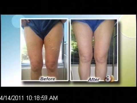 Optima Vein Care on KTVK's Your Life A to Z