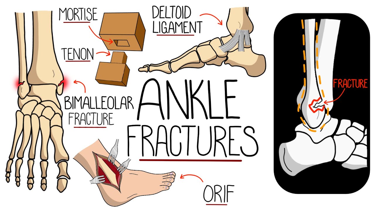 Ankle Fractures Made Easy