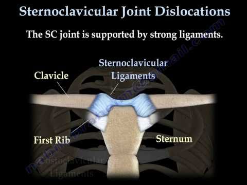 Sternoclavicular joint Dislocations - Everything You Need To Know - Dr. Nabil Ebraheim