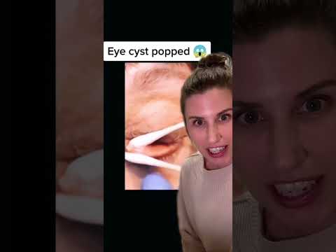 Eyelid Cyst Pop! Cyst of Zeis or Meibomian Cyst?!
