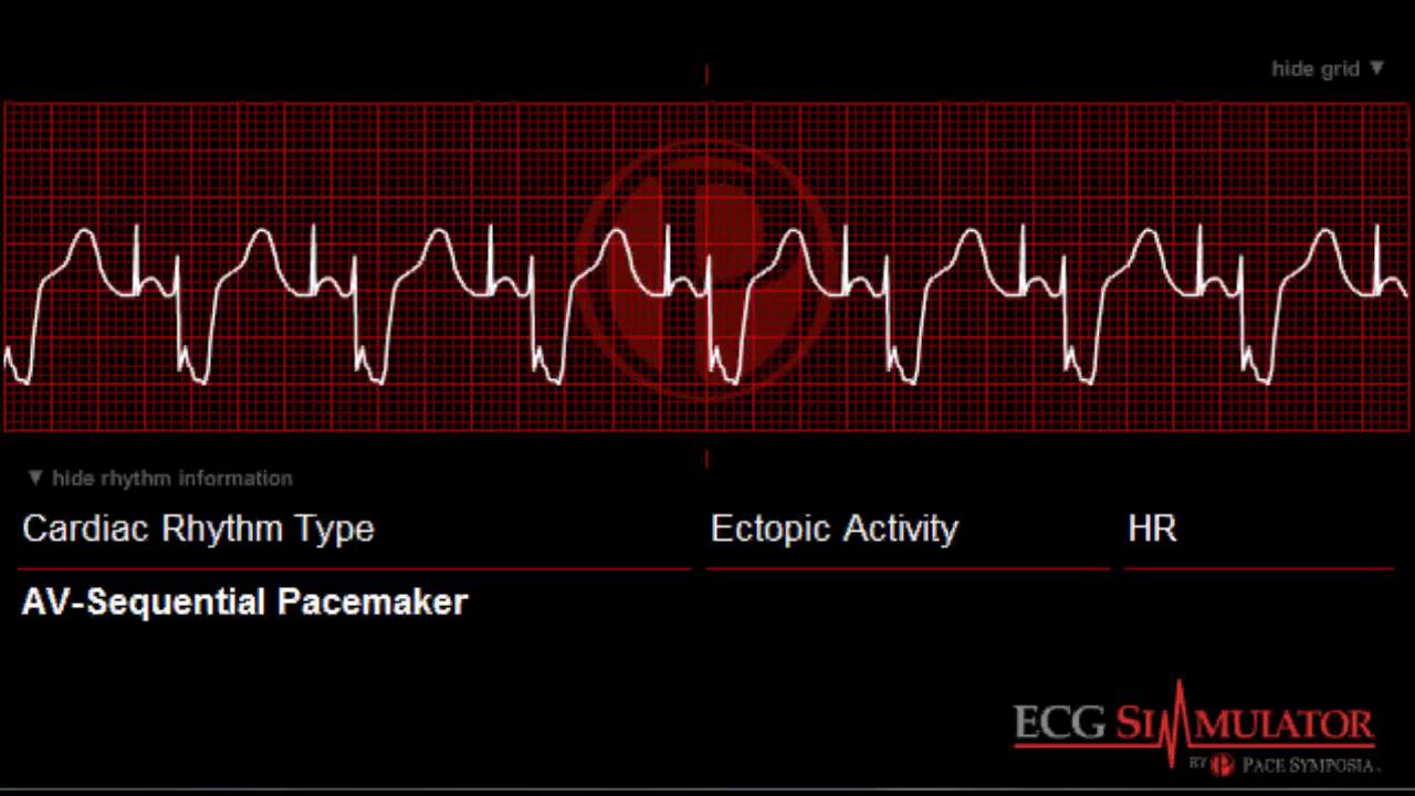 AV-Sequential Pacemaker ECG /EKG (ecgsimulator.net)