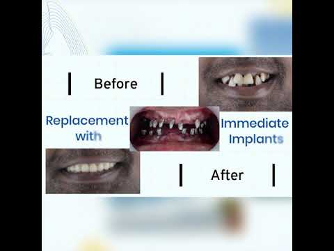 Immediate Implants|Full mouth rehabilitation|Dr Arshad|We Dental|Pride of Coimbatore|Implantologist