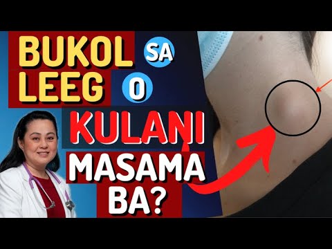 Bukol sa Leeg o Kulani: Masama Ba? - by ni Doc Liza Ramoso-Ong