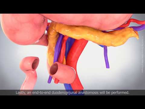 Segmental duodenal resection