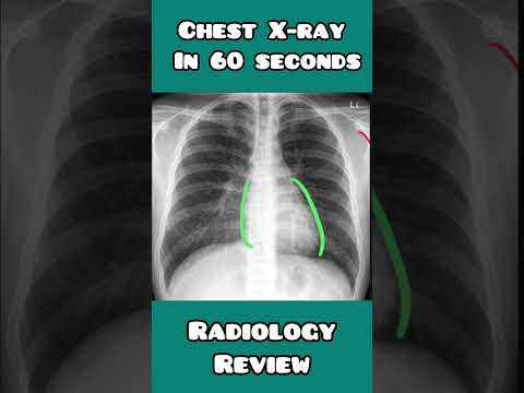 Chest X-ray interpretation in less than 60seconds  | USMLE, NCLEX, NEET PG, INICET