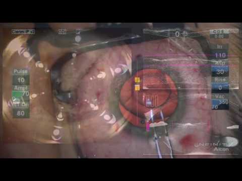 FLACS associated with better outcomes than manual surgery