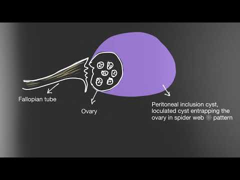 Peritoneal inclusion cyst - Risk factors ,Pathophysiology , Symptoms, Classic imaging and Treatment