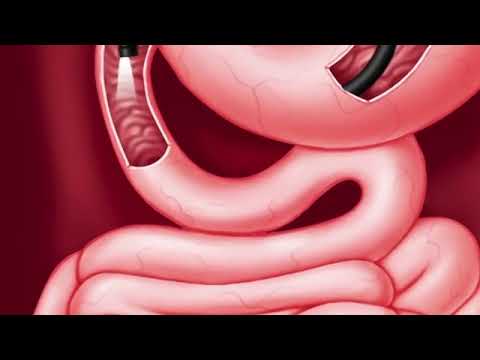 PreOp® Upper GI Endoscopy