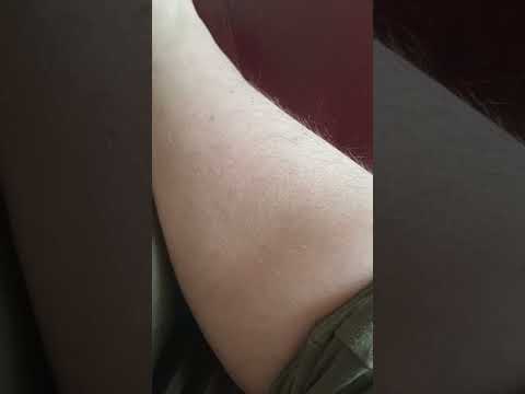 Muscle twitching after exercise