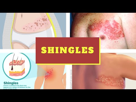 What Causes Shingles? Pictures, Signs, Symptoms, Treatment of Herpes Zoster Shingles Virus