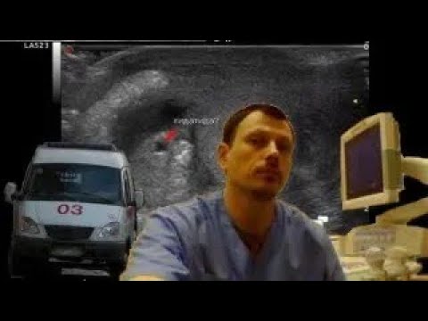 Pediatric Scrotal ultrasound - Acute orchoepididymitis presumably secondary to hydatide torsion