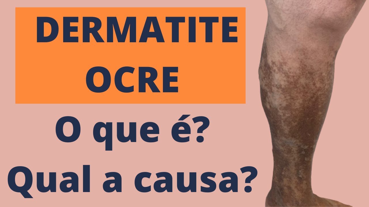 Flebite: O que é, causas e tratamento - Dr. Victor Hugo