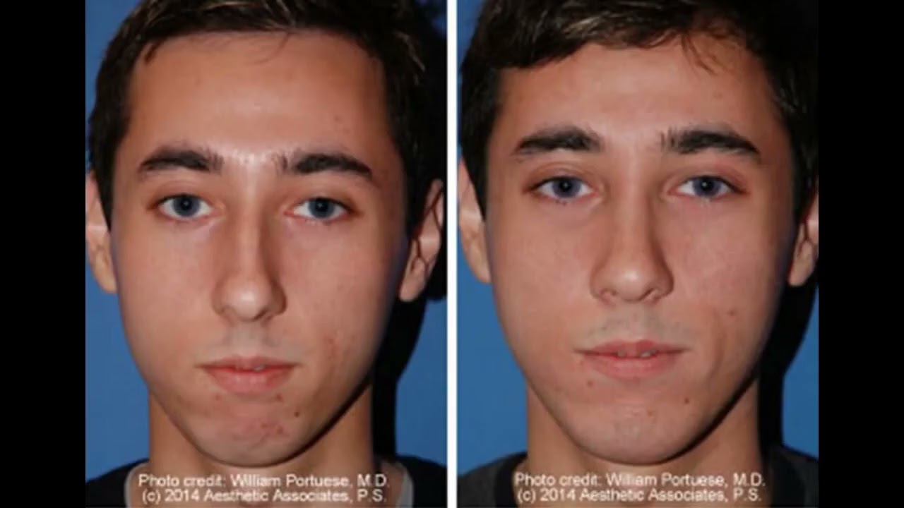 Rhinoplasty in Seattle Washington | Nose Job Expert Seattle WA