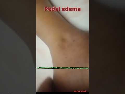 Pedal edema in tamil|swelling in legs|pittinng|peripheral edema|lower extremity edema