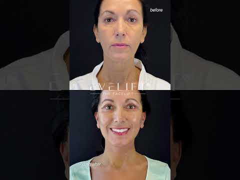 EVE Lift™ Weekly Recap-June 15th | Eden Plastic Surgery: Dr. Ali Charafeddine, MD