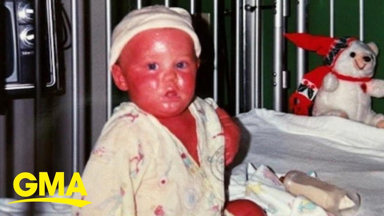 Tips for living with generalized pustular psoriasis (GPP)