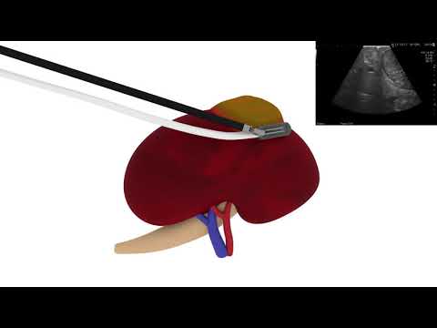 FUJIFILM Drop-In Ultrasound Probe for Robot-Assisted Partial Nephrectomy.