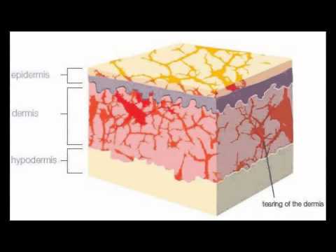 How Stretch Marks are Formed