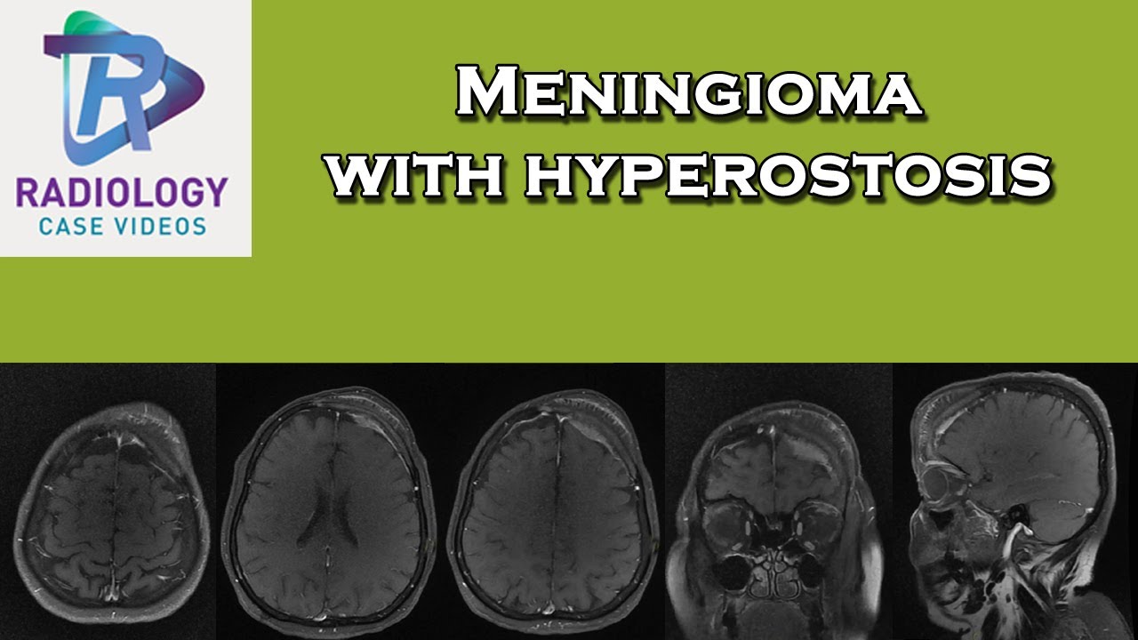 Meningioma with hyperostosis