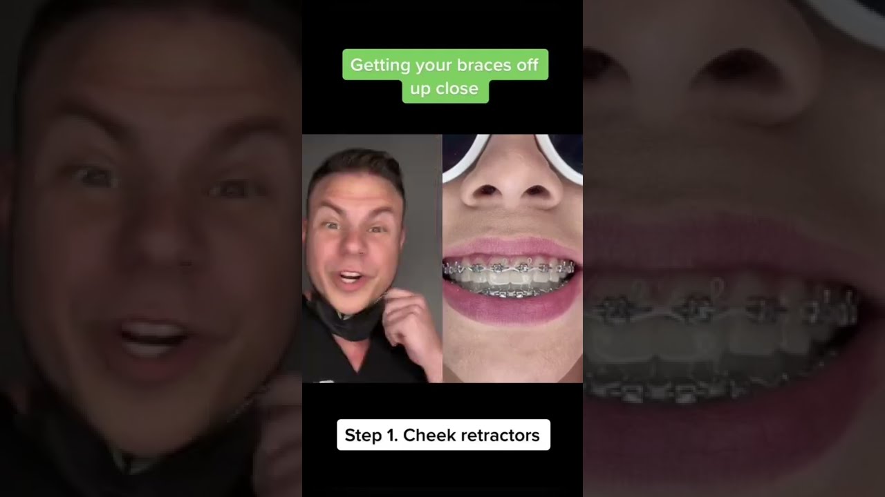 POV: You’re Getting Your Braces Off #shorts