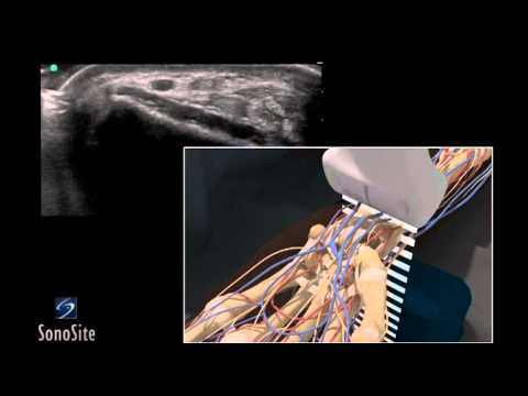 How To: Ultrasound Guided Radial Artery Catheterization (Trans) 3D Video