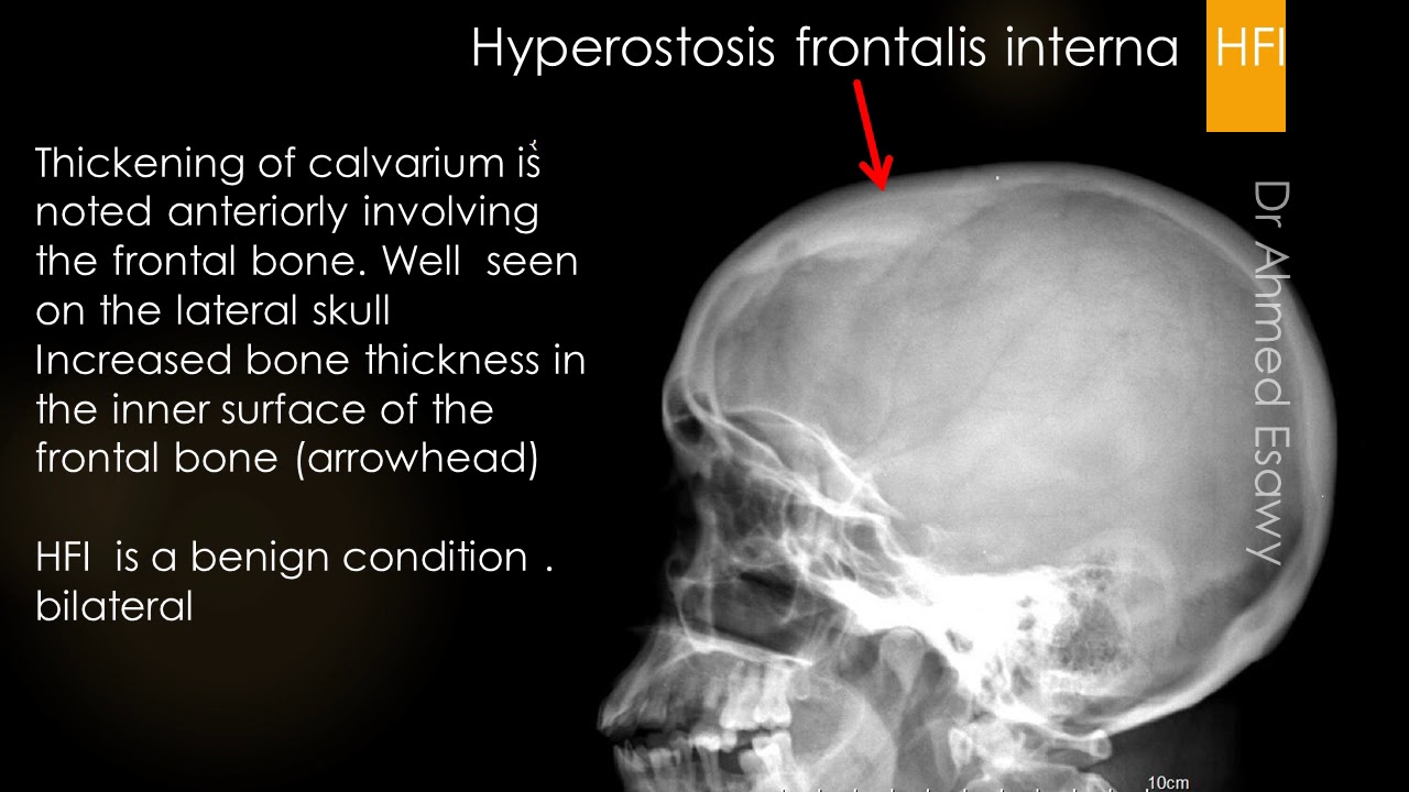 CASE 608 Hyperostosis frontalis interna  HFI