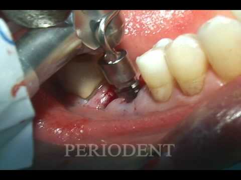 Molar Extraction and Immediate Implant Placement | İMPLANT MARKALARI