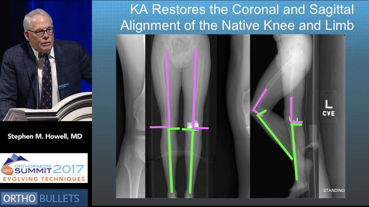 Pro: Kinematic Alignment Is All That Matters! - Stephen M. Howell, MD