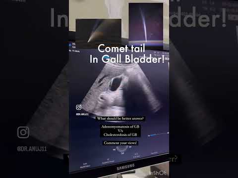Comet tail in Gall bladder on Ultrasound-Adenomyomatosis & Cholesterolosis! #radiology #ultrasound