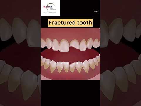 Composite Filling for Fractured Tooth #brokentooth #cavity #dentist