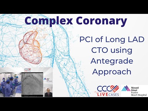 PCI of Long LAD CTO using Antegrade Approach